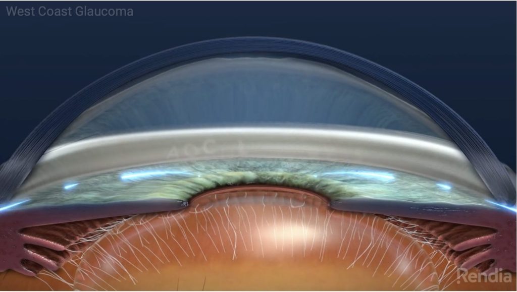 West Coast Glaucoma Dr Robert Schertzer Inc West Coast Glaucoma